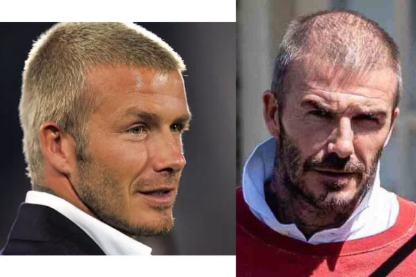 David Beckham Hair Loss: Investigating the Facts – nicehair.org